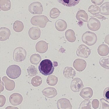 Microcytic and Hypochromic Red Cells - haematologyetc.co.uk