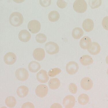 Pappenheimer Bodies - haematologyetc.co.uk