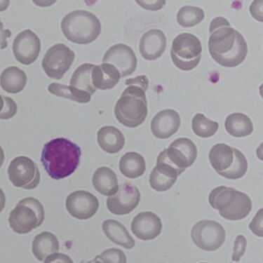 Microcytic and Hypochromic Red Cells - haematologyetc.co.uk