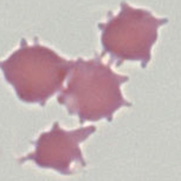 Acanthocytes - haematologyetc.co.uk