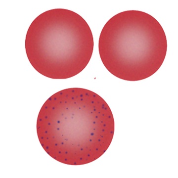 Basophilic stippling - haematologyetc.co.uk