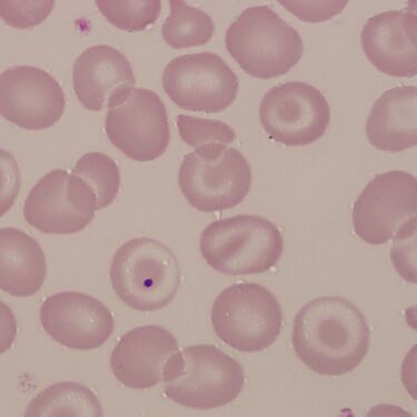 Howell Jolly bodies - haematologyetc.co.uk