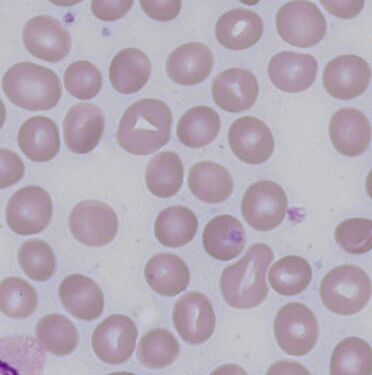 Stomatocytes - haematologyetc.co.uk