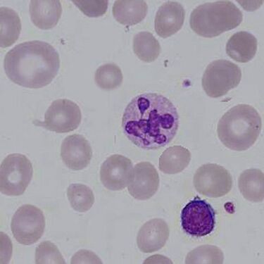 Macrocytic Red Cells - haematologyetc.co.uk
