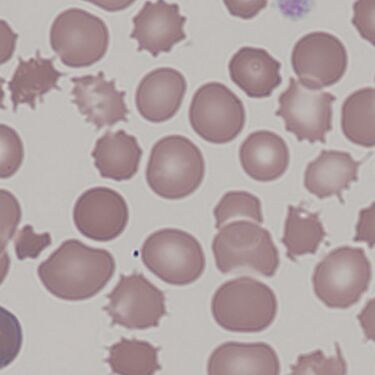 Acanthocytes - haematologyetc.co.uk