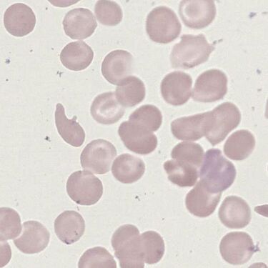 SC poikilocytes - haematologyetc.co.uk