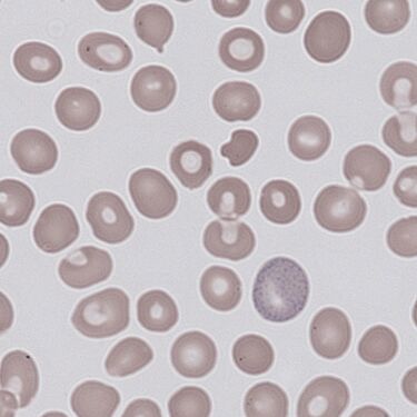 Basophilic stippling - haematologyetc.co.uk