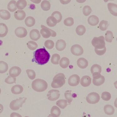 Microcytic and Hypochromic Red Cells - haematologyetc.co.uk