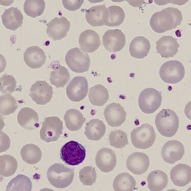 Acanthocytes - haematologyetc.co.uk