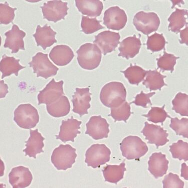 Acanthocytes - haematologyetc.co.uk