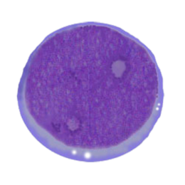 Acute leukaemia types - haematologyetc.co.uk