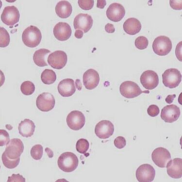 Microspherocytes - haematologyetc.co.uk