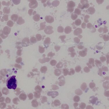 Microspherocytes - haematologyetc.co.uk