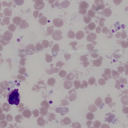 Microspherocytes - haematologyetc.co.uk