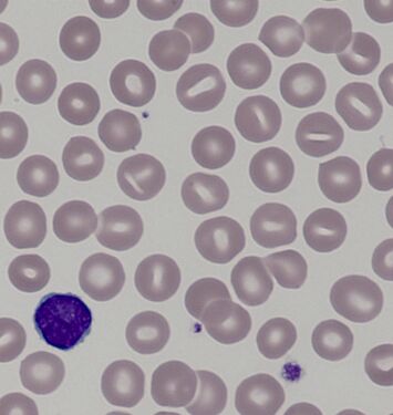 Stomatocytes - haematologyetc.co.uk