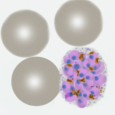Plasmodium ovale: Morphology - haematologyetc.co.uk