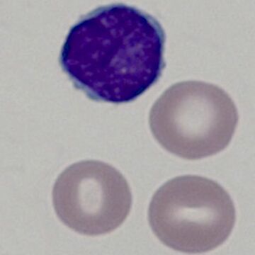 Stomatocytes - haematologyetc.co.uk