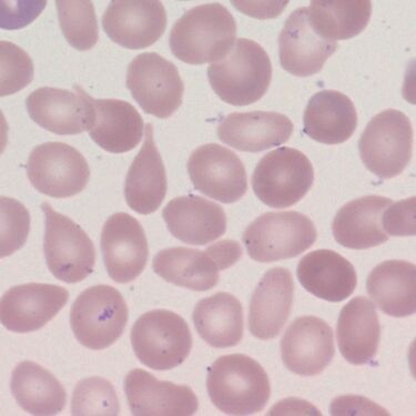 Teardrop cells - haematologyetc.co.uk