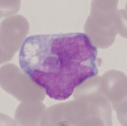 Recognition of blast cells with monocytic differentiation - haematologyetc.co.uk