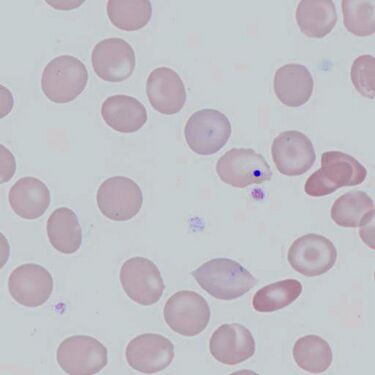 Howell Jolly bodies - haematologyetc.co.uk