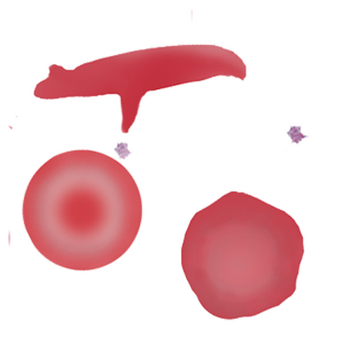 SC poikilocytes - haematologyetc.co.uk