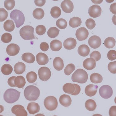 Polychromatic Red Cells - haematologyetc.co.uk