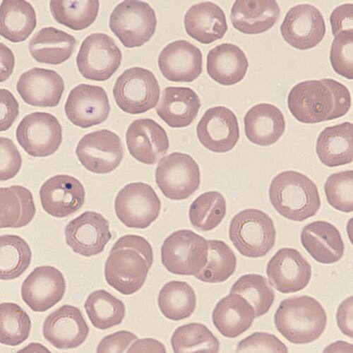 Stomatocytes - haematologyetc.co.uk